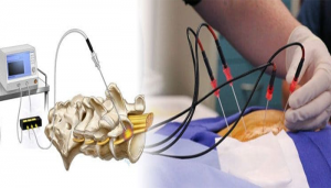 Radio Frequency Ablation – Spinal Pain Rehab